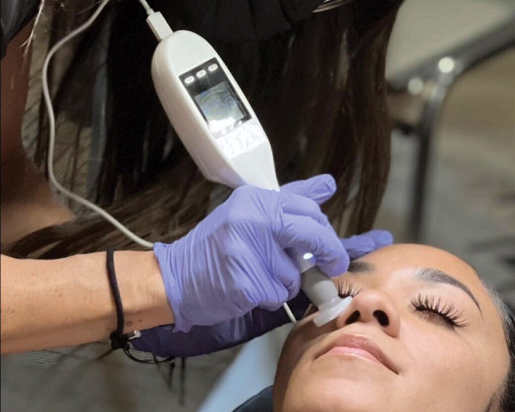 The Benefits of Plasma Jet for Skin – TanyaMartin.com